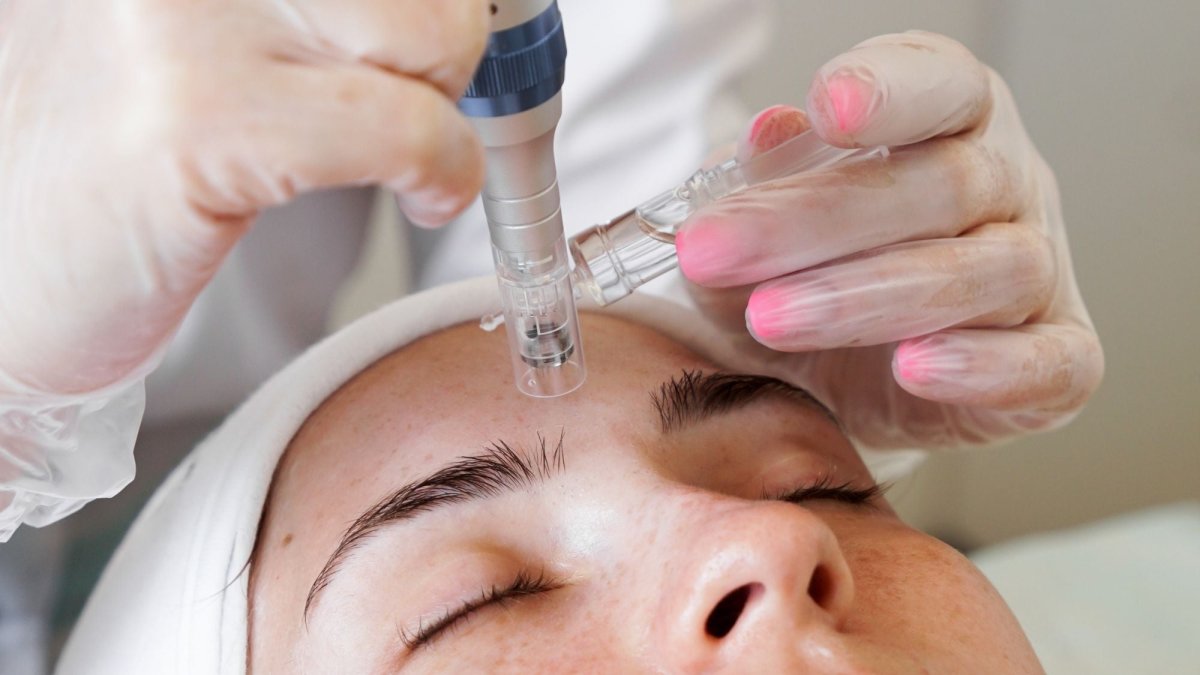 Microneedling - Here's What you Need to Know – Beauty Pro Supplies Canada
